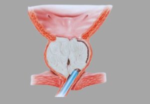 Dr. Sandeep Prabhakaran's UroLift Proficiency Certification